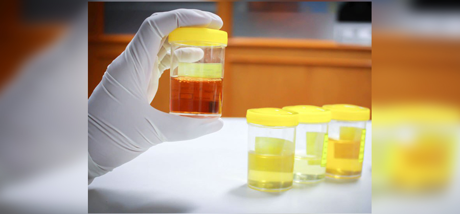 ကျင်ငယ်ရေကို အသုံးပြုပြီး ကုသတဲ့ "Urine Therapy" ကုထုံးရဲ့ ကောင်းကျိုးများ